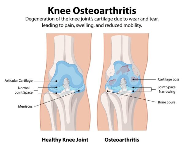 Knee Safety: 10 Essential Practices for Protecting Your Knees at Work ...